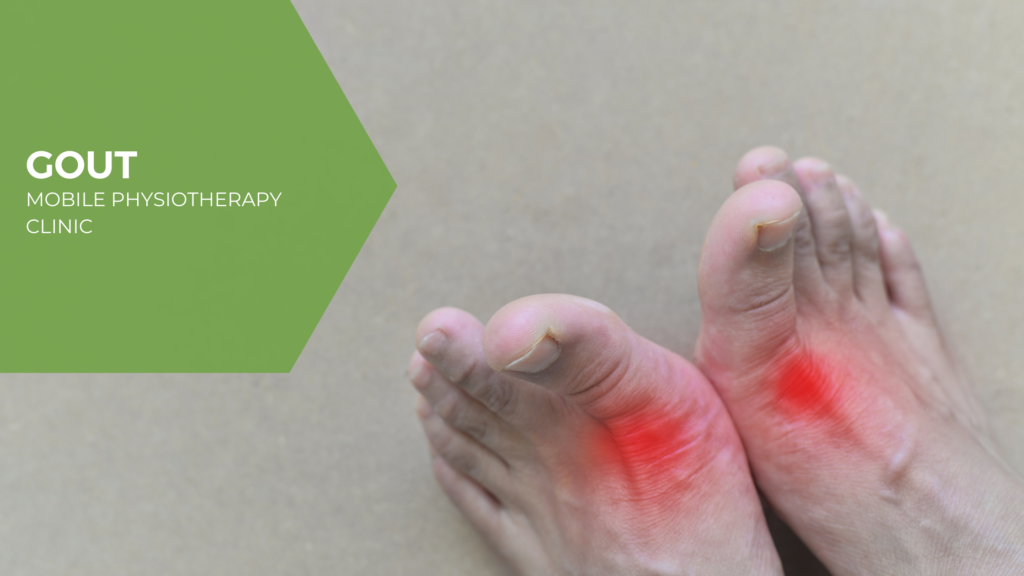 Gout - Samarpan Physiotherapy Clinic Ahmedabad
