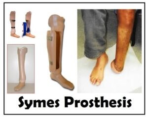 Amputation Of Lower Limb: Indication, Type, Treatment
